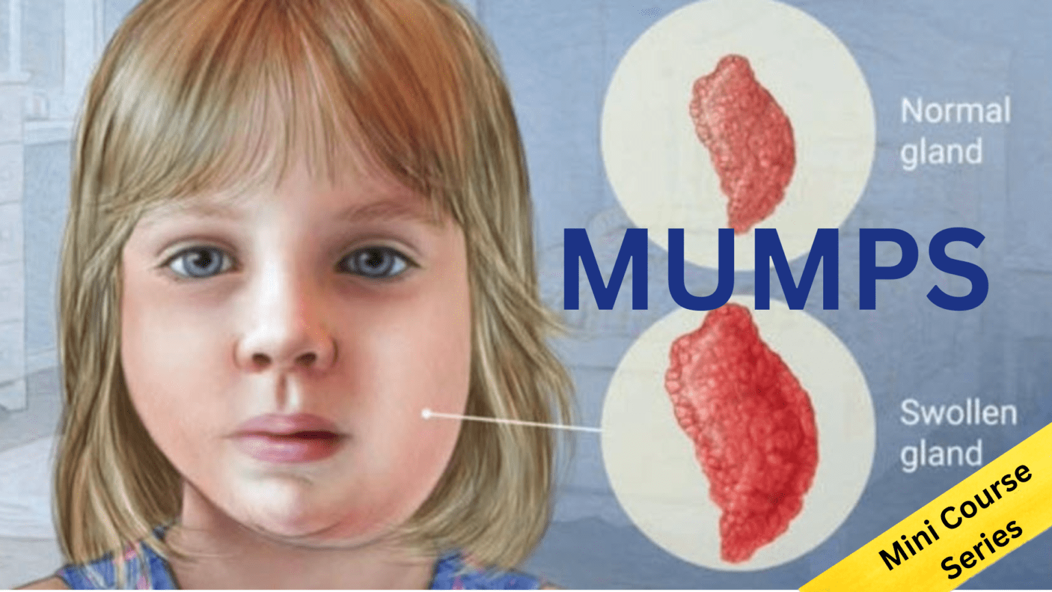 Mini Course Series - Mumps - Learning4You